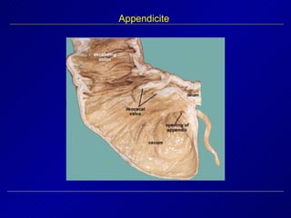 Appendicite | PPT