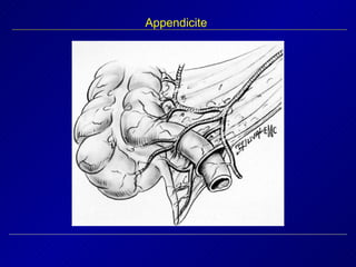 Appendicite | PPT