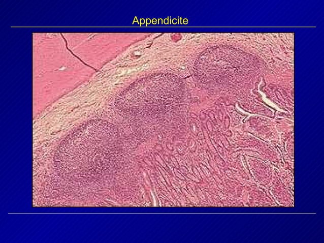 Appendicite | PPT