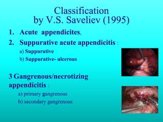 appendicite.pptx