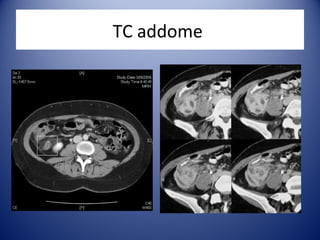 Appendicite acuta | PPT | Medical Health
