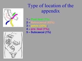 appendicite4 — копия.pptx