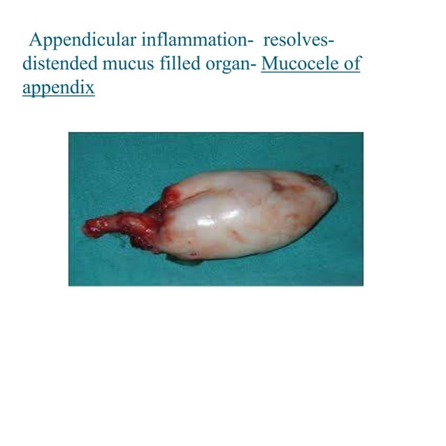 Appendicitis | PPTX | Digestive Disorders | Diseases and Conditions