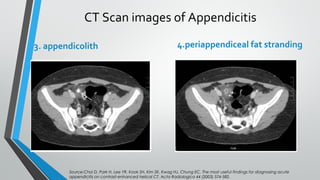 Appendicitis | PPT