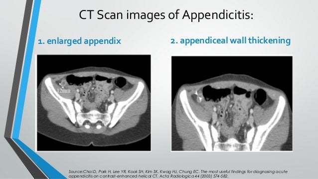Chronic Appendicitis Symptoms Treatment And Outlook
