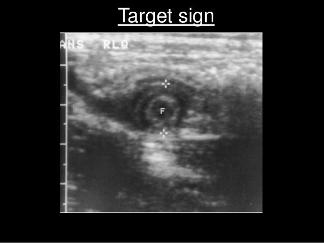 Imaging in Appendicitis