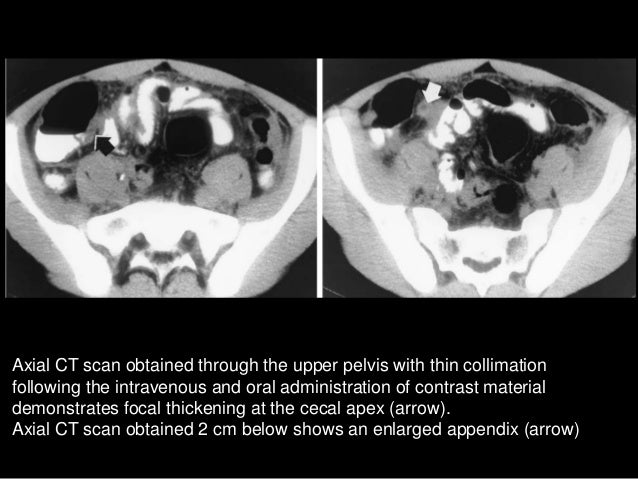 Imaging in Appendicitis