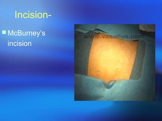 PPT on Appendicitis by Mr. ASHOK BISHNOI | PPT