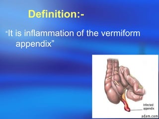 PPT on Appendicitis by Mr. ASHOK BISHNOI | PPT