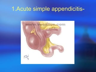 PPT on Appendicitis by Mr. ASHOK BISHNOI | PPT