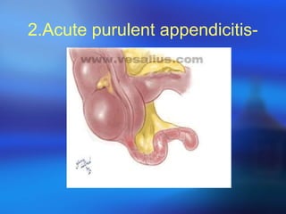 ppt on Appendicitis by ASHOK BISHNOI LOHAWAT JODHAPUR | PPT