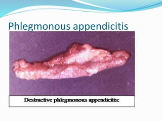 Appendicitis PPT By Dr Anil Kumar, Assist Professor,Gen Surgery, AIIMS ...