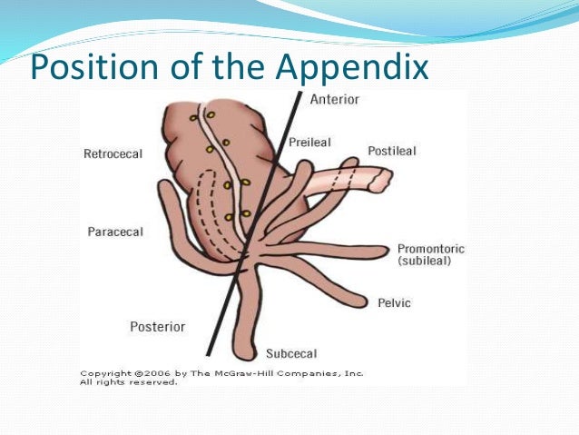 Appendicitis PPT By Dr Anil Kumar, Assist Professor,Gen Surgery, AIIM…