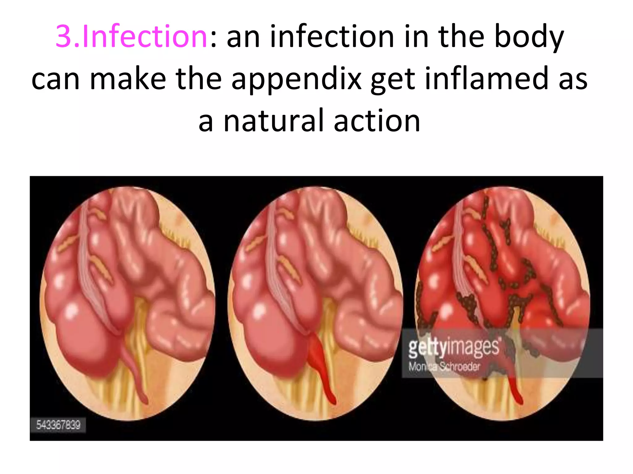 Appendicitis | PPTX