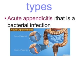 Appendicitis | PPT