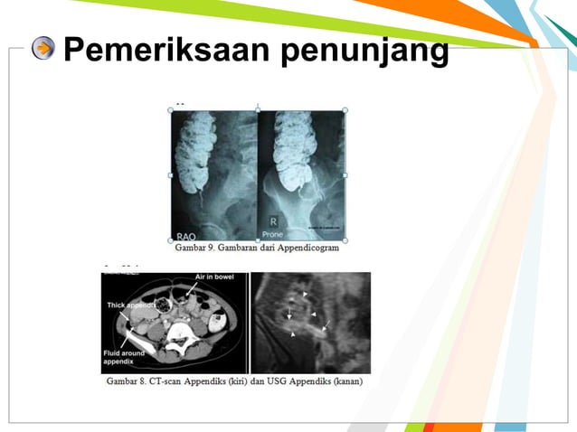 Appendicitis) | PPTX