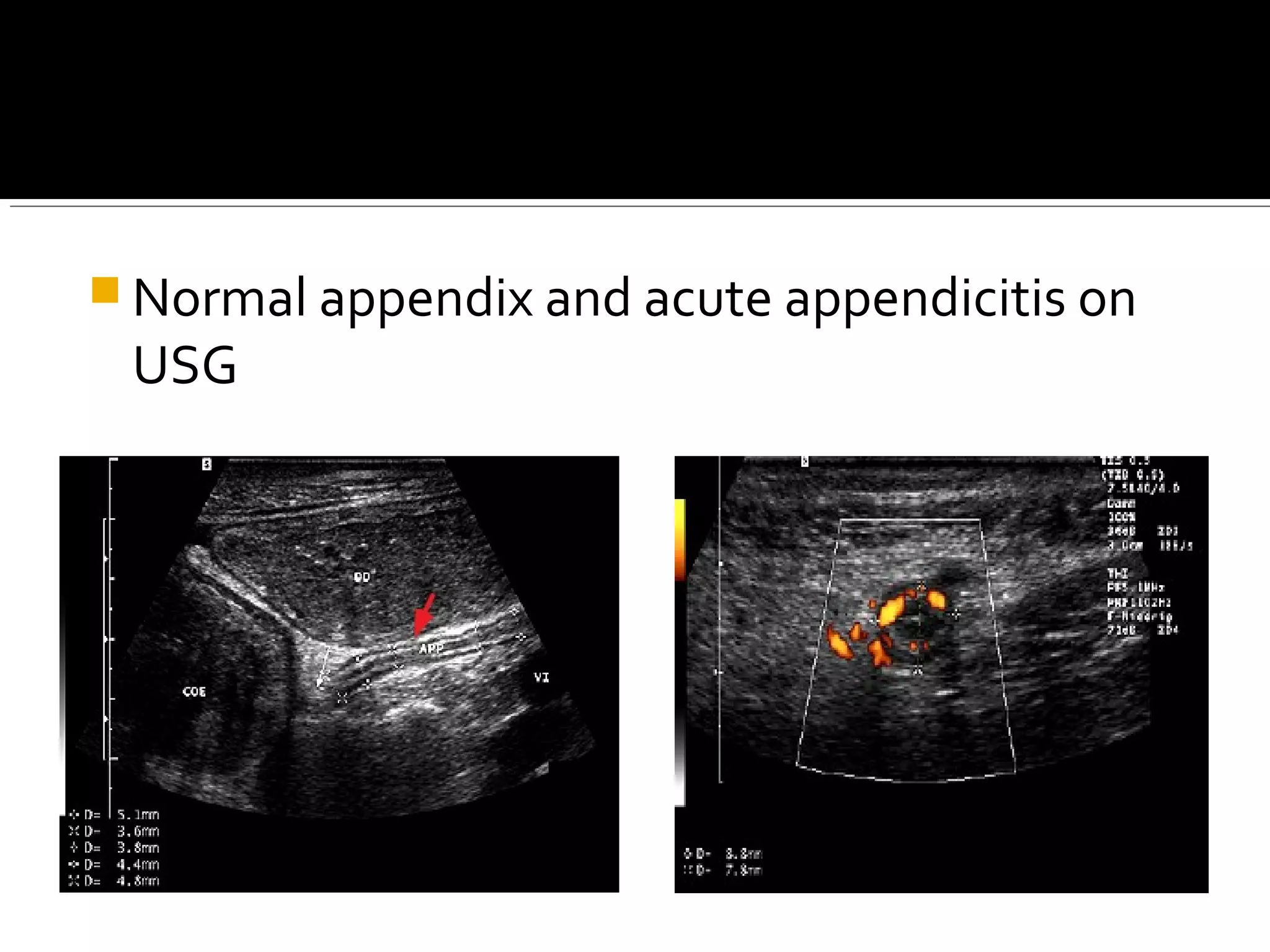 Appendicitis | PPT