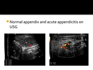 Appendicitis | PPT