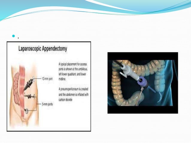 Appendicitis | PPTX | Digestive Disorders | Diseases and Conditions