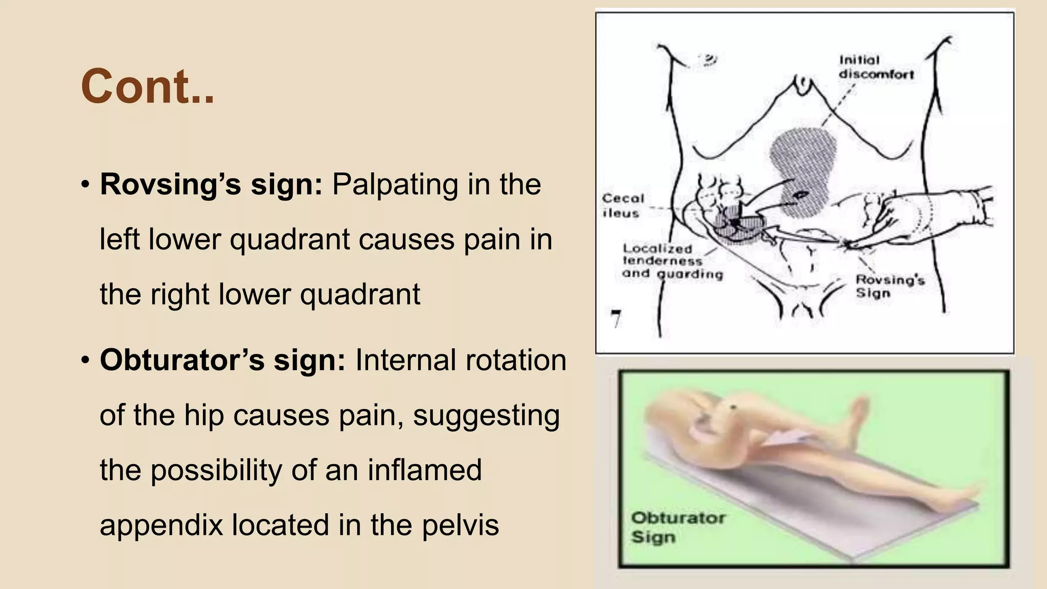 Appendicitis | PPTX