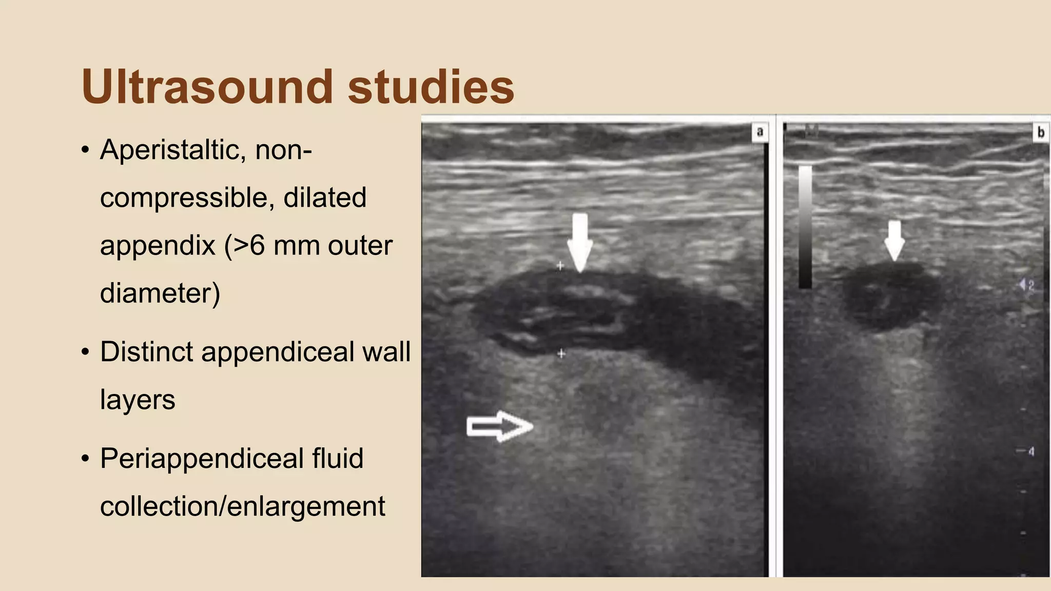 Appendicitis | PPTX