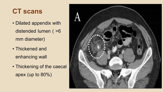 Appendicitis | PPTX