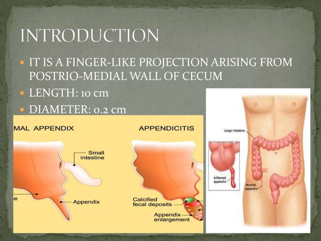 Appendicitis | PPT