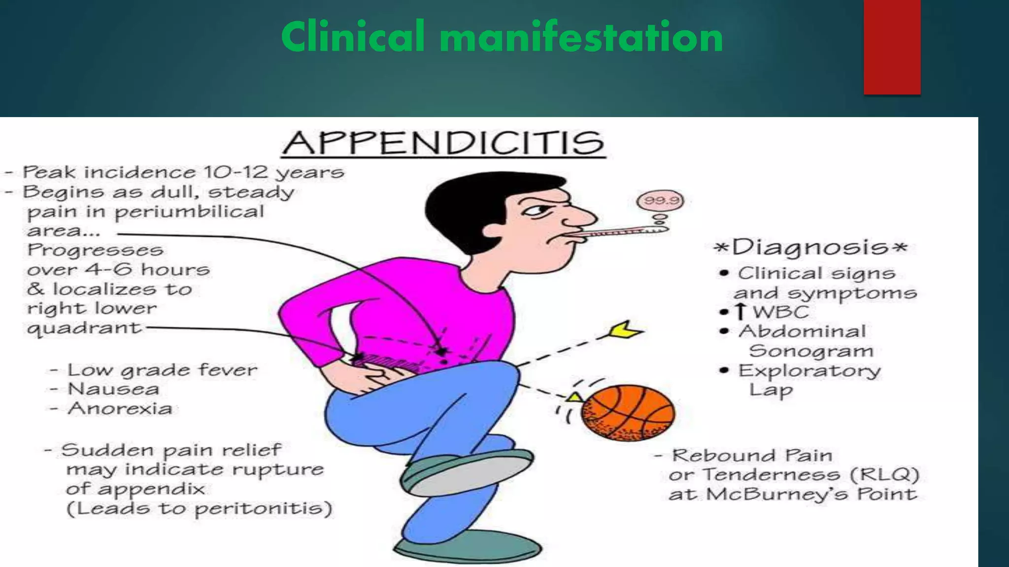 Appendicitis | PPTX