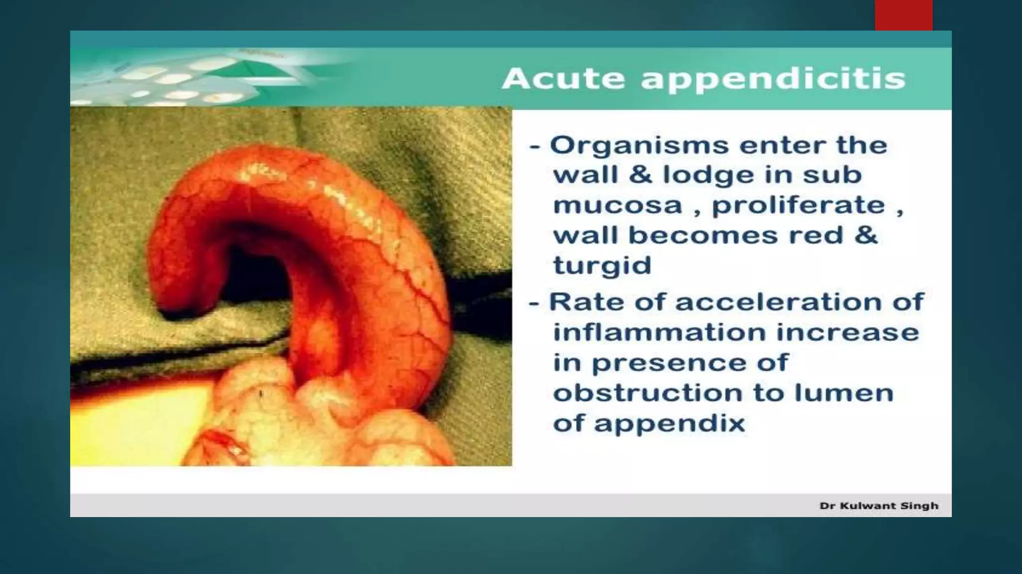 Appendicitis | PPTX