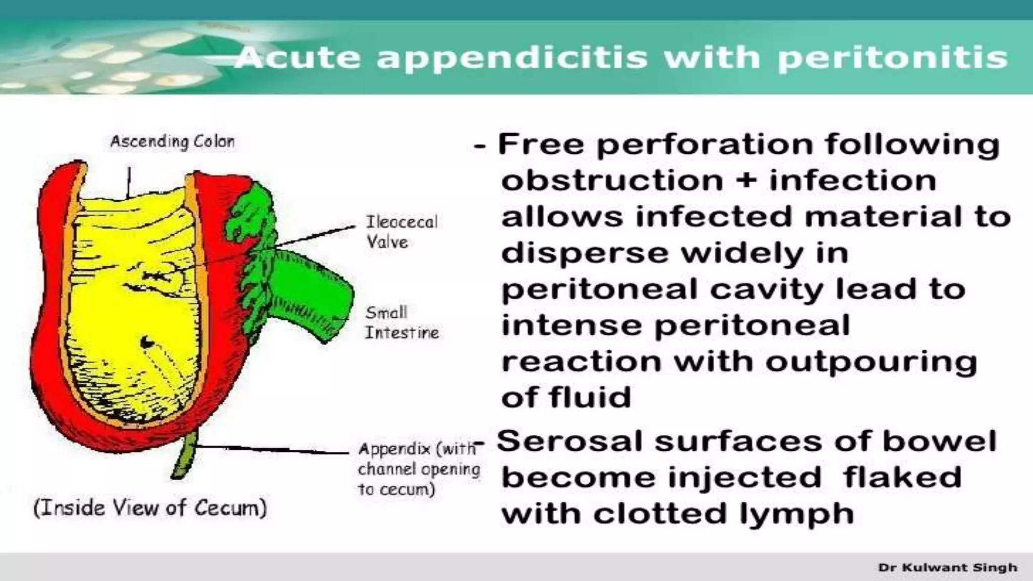 Appendicitis | PPTX