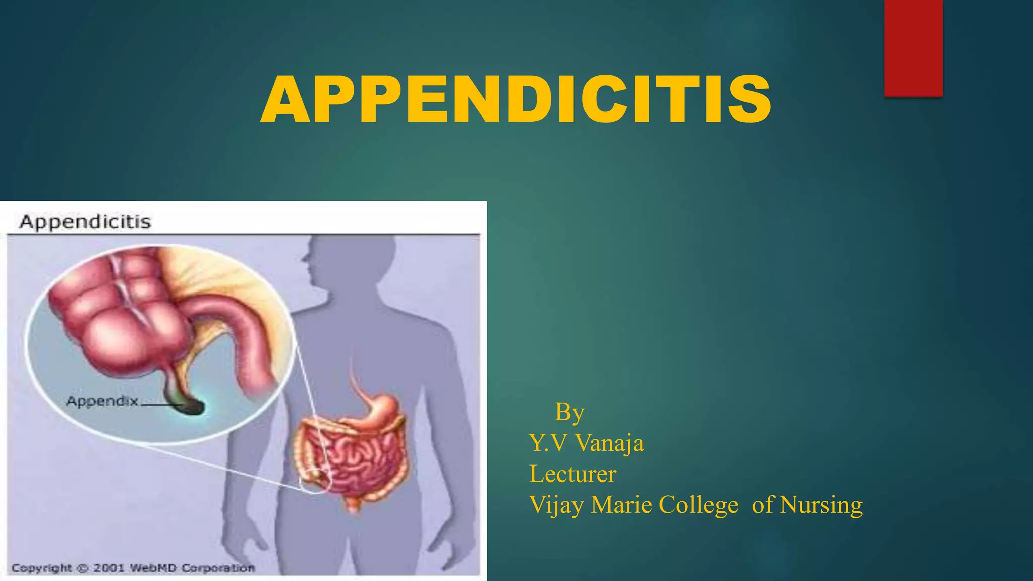 Appendicitis | PPT