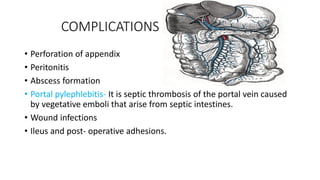 Appendicitis | PDF