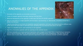 APPENDICITIS | PPT