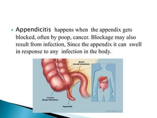 Appendicitis | PPT
