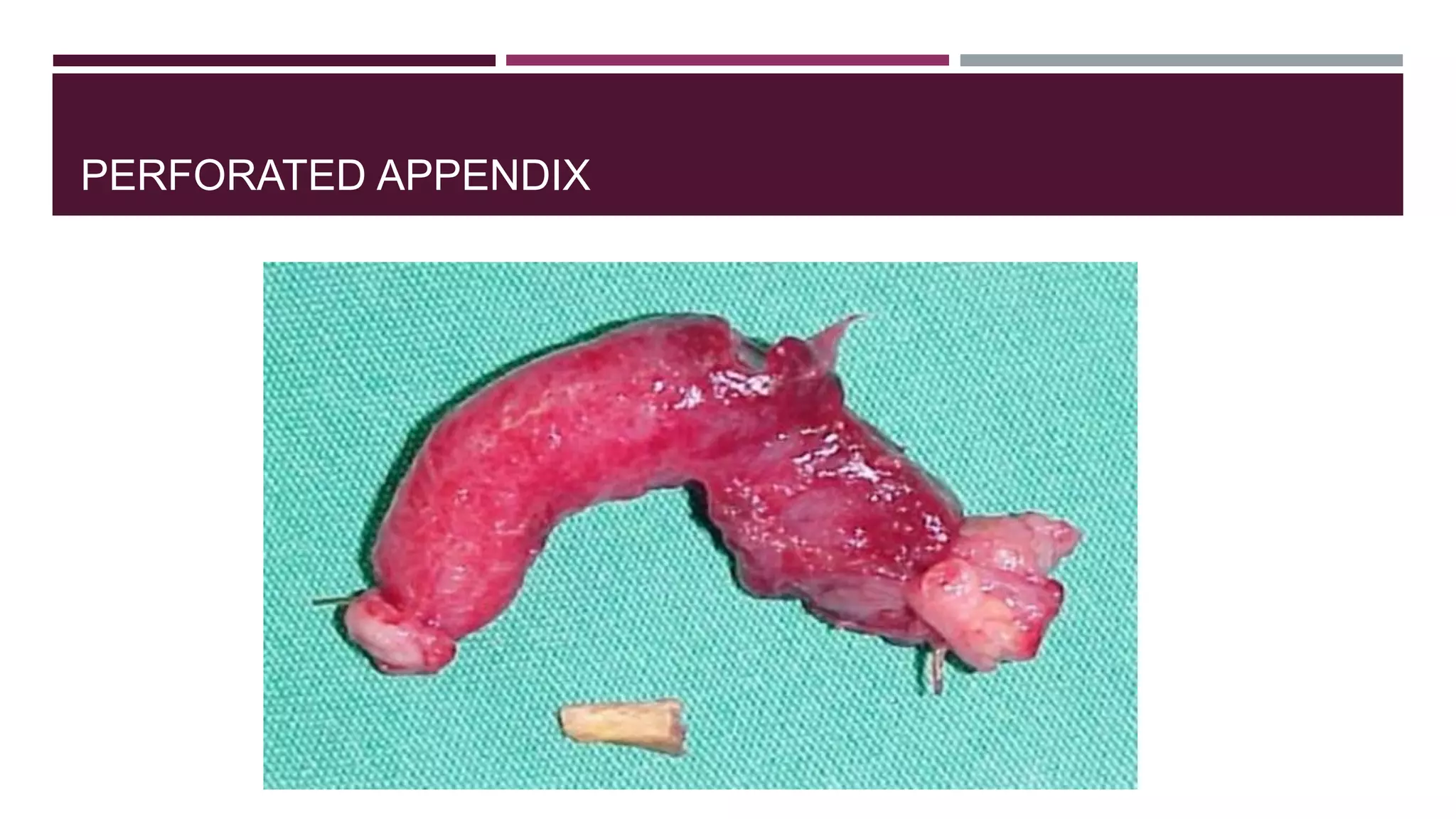 appendicitis.ppt