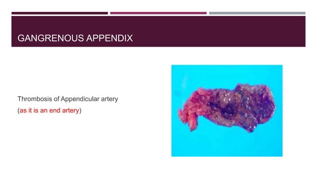 appendicitis.ppt