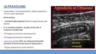 appendicitis.pptx