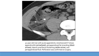 appendicitis.pptx