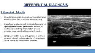 appendicitis.pptx