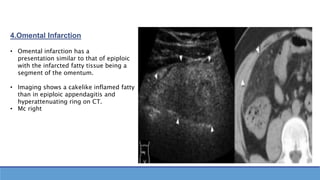appendicitis.pptx