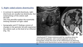 appendicitis.pptx