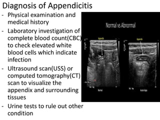 Appendicitis.pptx | Digestive Disorders | Diseases and Conditions