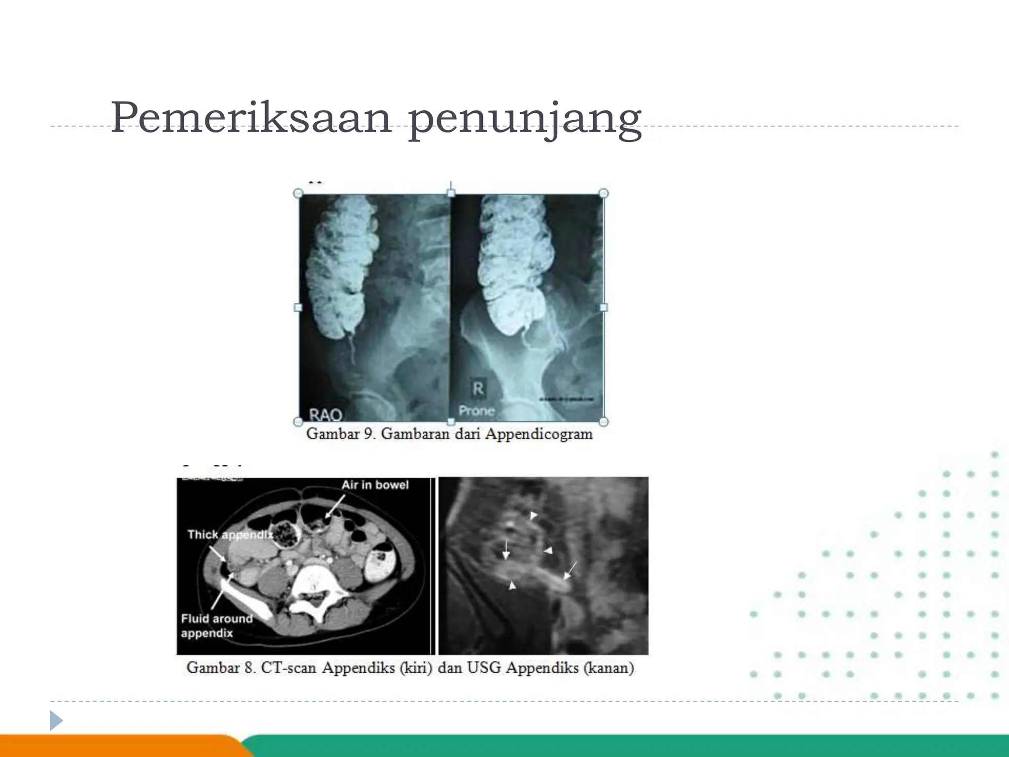 appendicitis kasus terbanyak dewasa.pptx