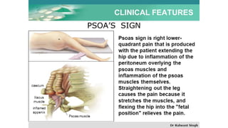 Appendicitis.pptx types clinical features | PPTX