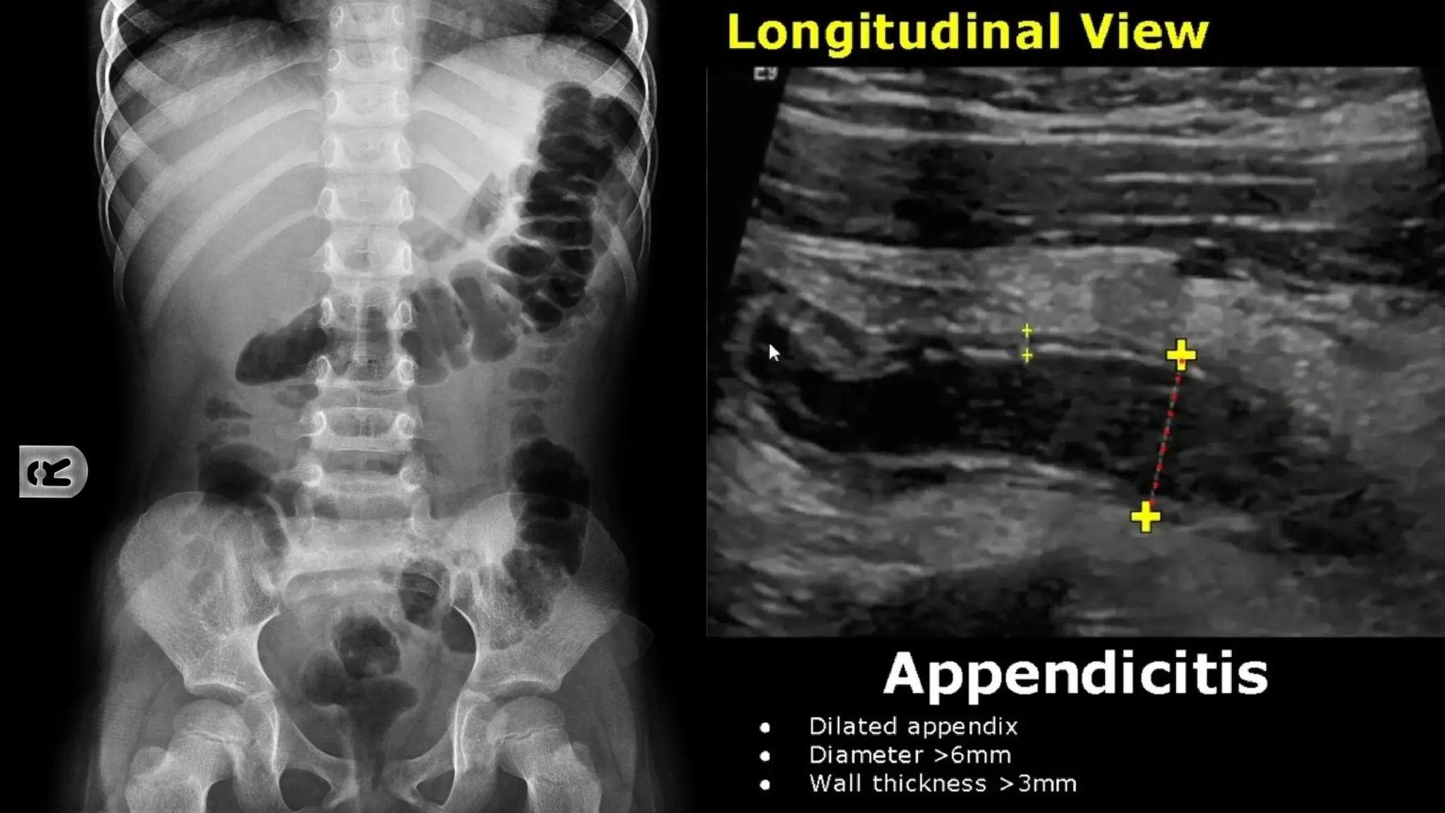 APPENDICITIS.pptx- introduction, definition, causes, sign and symptoms ...