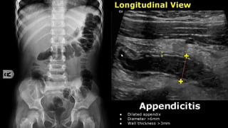 APPENDICITIS.pptx- introduction, definition, causes, sign and symptoms ...