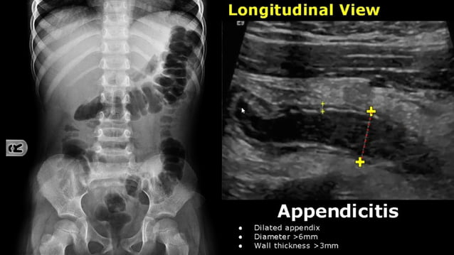 APPENDICITIS.pptx- introduction, definition, causes, sign and symptoms ...