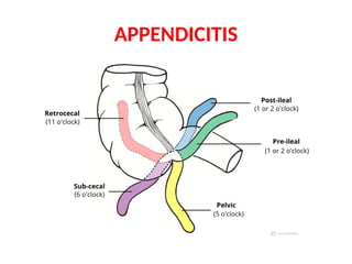 APPENDICITIS AND ITS MANAGEMENT......... | PPT