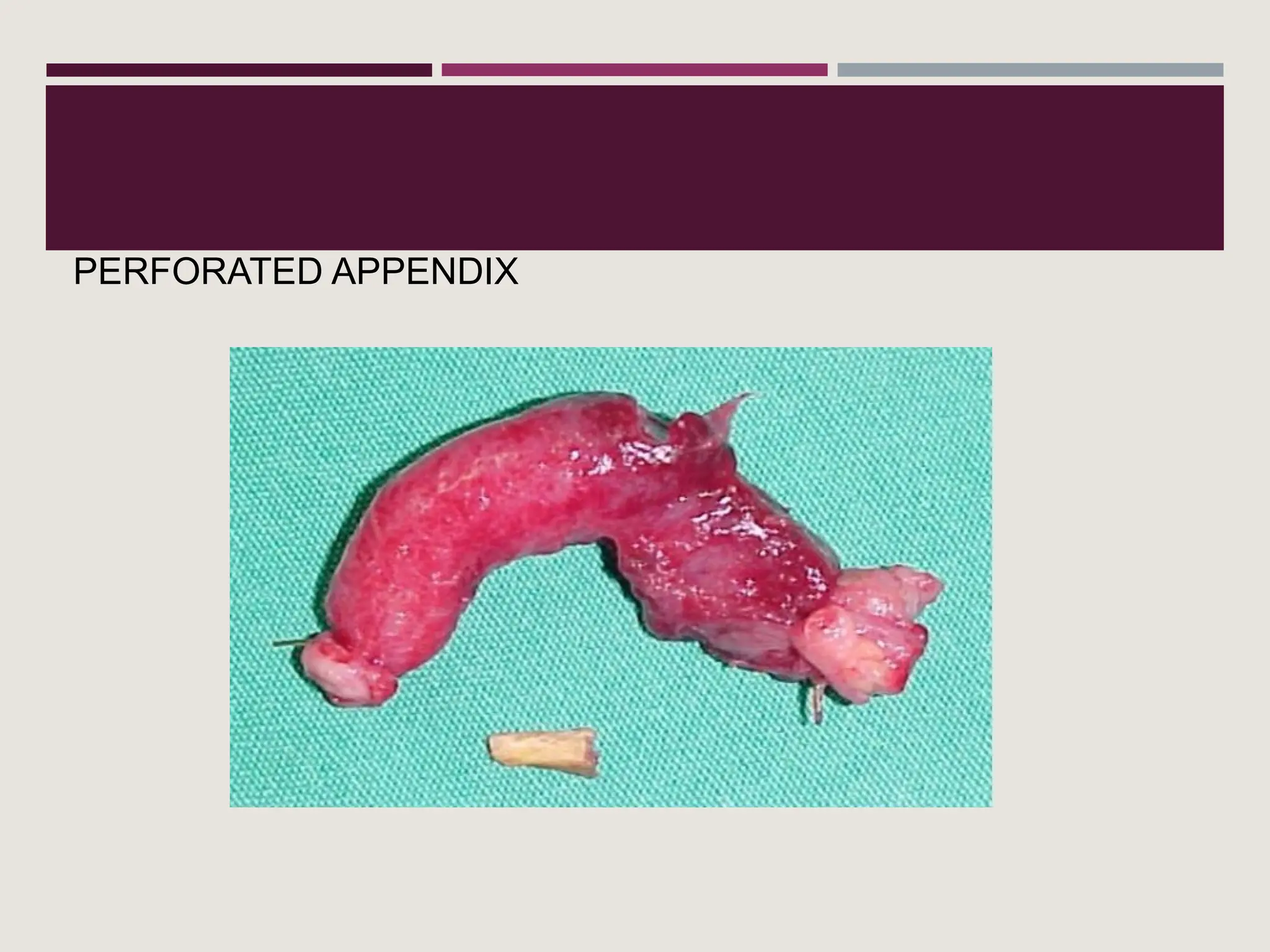 appendicitis.pptx appendectomy appendix a | PPT