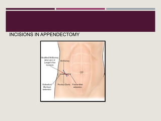 appendicitis.pptx appendectomy appendix a | PPT